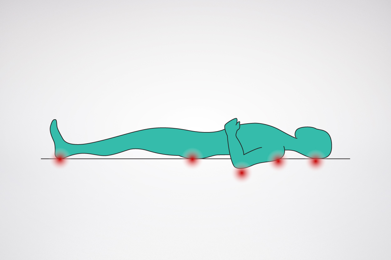 Úlceras por presión