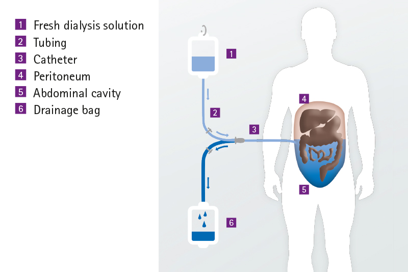 Peritoneal dialysis